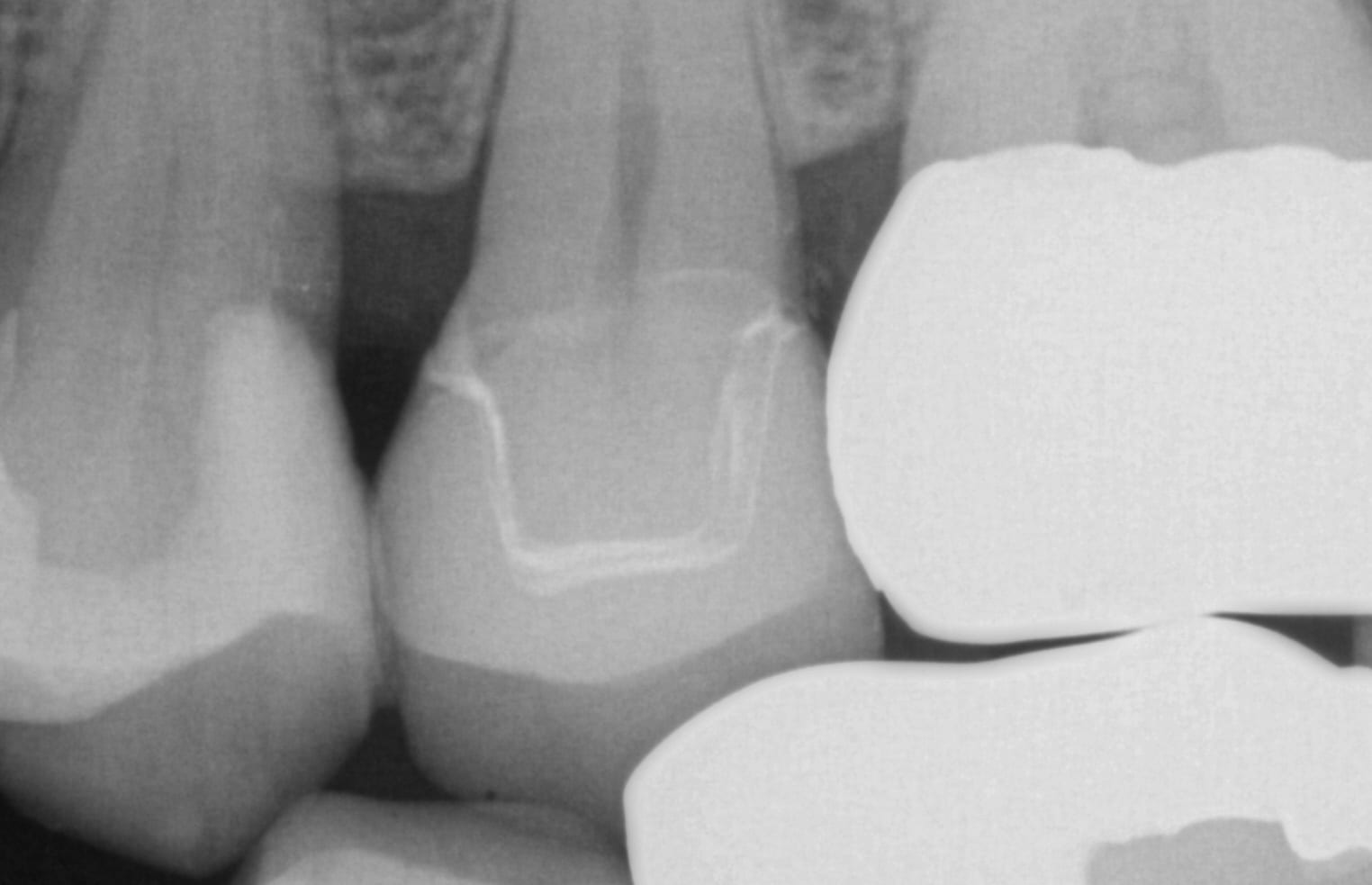 Premolar Anatomic Copy Case with Medit i500, exocad, and imes icore ...